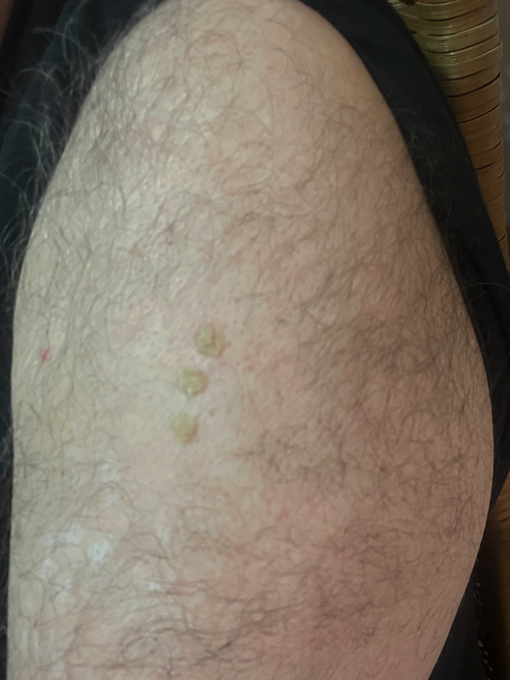 “Kambo” also known as “Sapo” | Peru - The Amazon